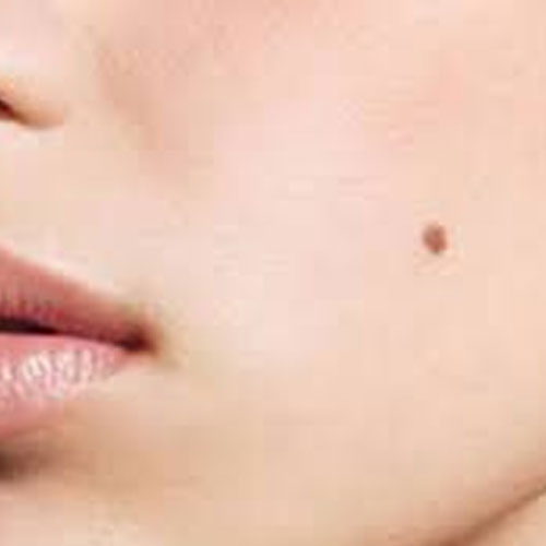 ¿Qué diferencia existe entre las pecas, lunares y manchas de la piel y ...